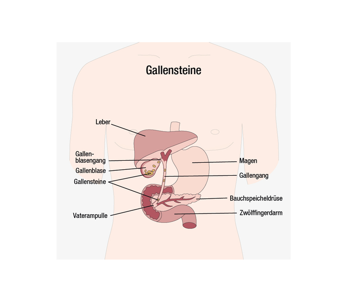 Gallensteine | Marien Hospital Herne